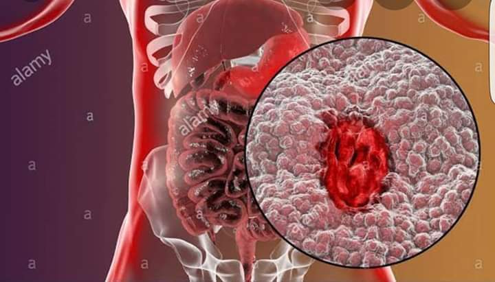 What is ULCER? and How to Cure it with Norland Mebo GI Capsule. - Youth ...